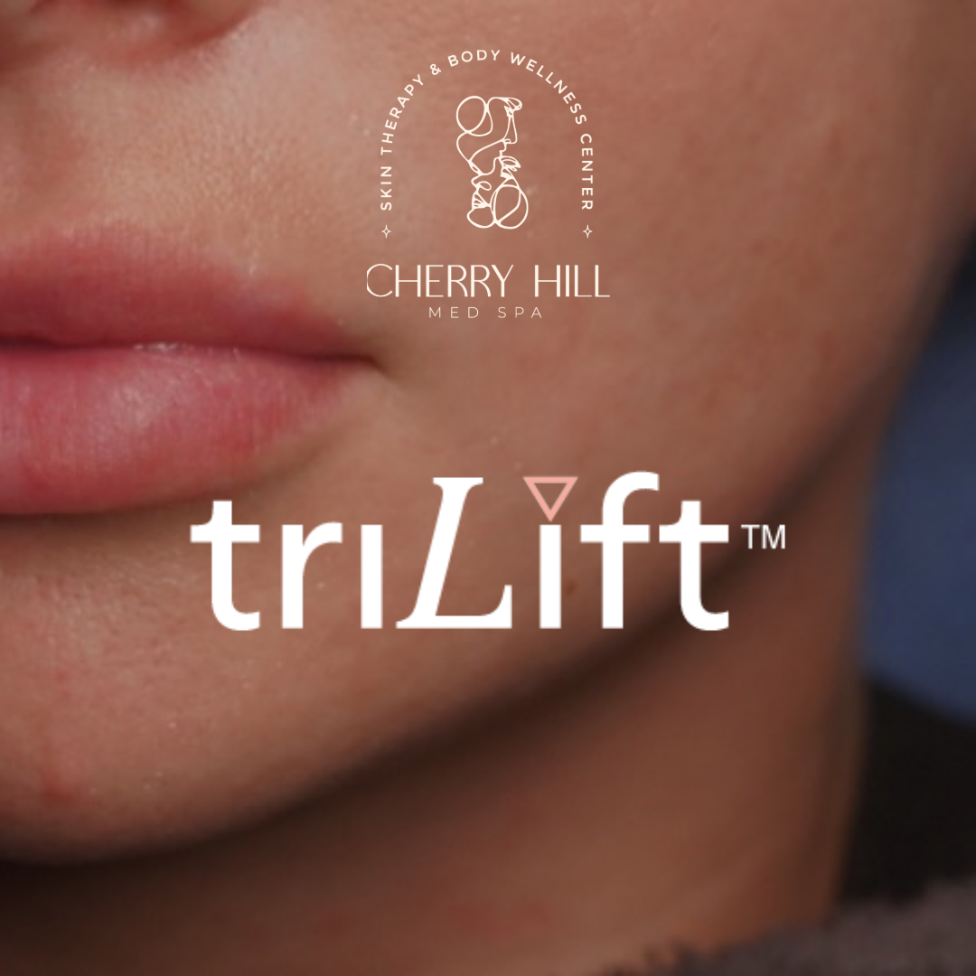 Tri-Lift – Cherry Hill Med Spa